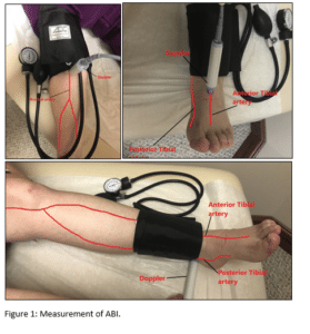 Ankle-Brachial Index – The Society for Vascular Medicine